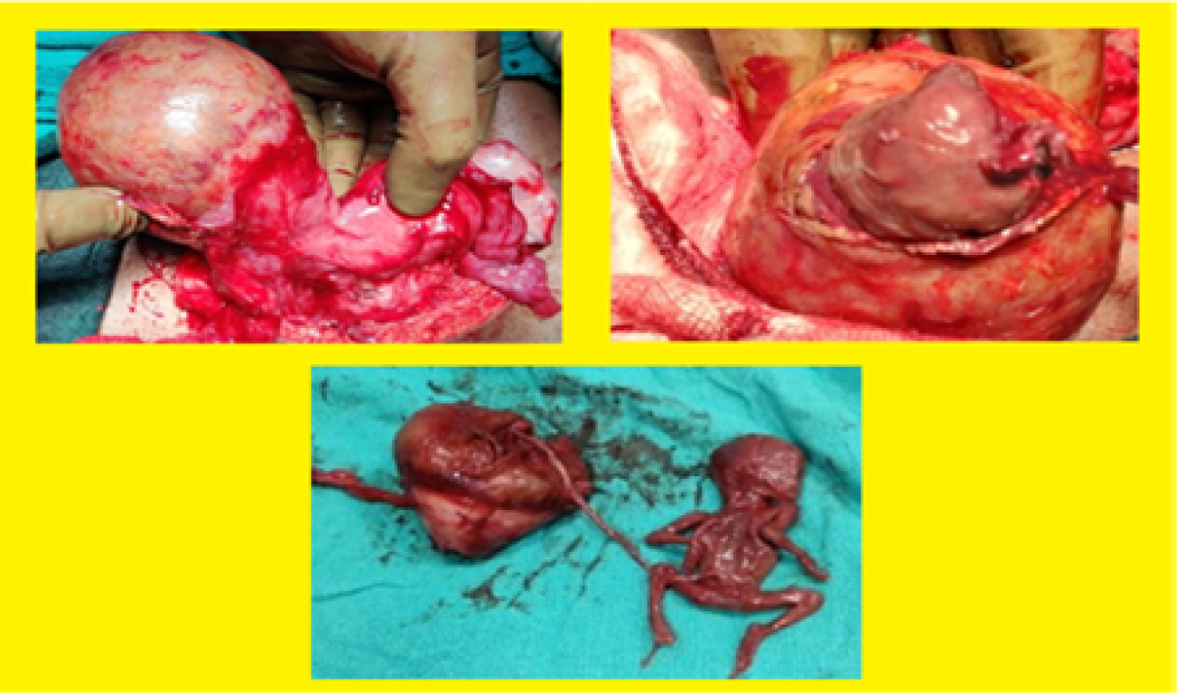 Pregnancy in Rudimentary Horn: A Case Report | Himalayan Journal of ...