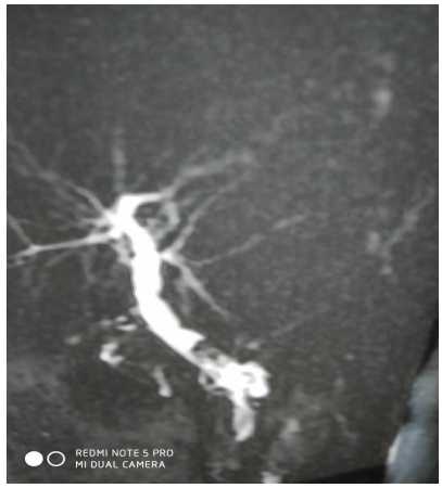 An Interesting Case of Cholecystoduodenal Fistula | Himalayan Journal ...