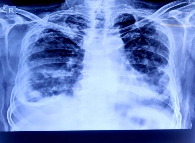 Pulmonary Aspergillosis with Pyopneumothorax – A Case Report ...